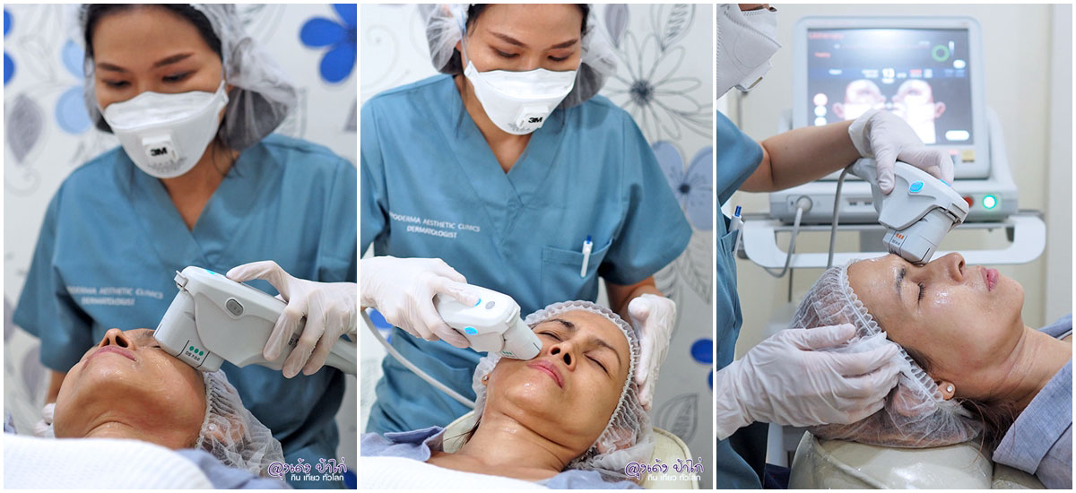 Ulthera SPT ที่ไหนดี : Proderma คลีนิก - รีวิว by ลุงเด้ง ป้าไก่