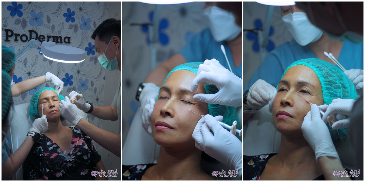 ฟิลเลอร์ร่องแก้ม ใต้ตา ยกหน้า ProDerma Clinic - รีวิว by ลุงเด้ง ป้าไก่