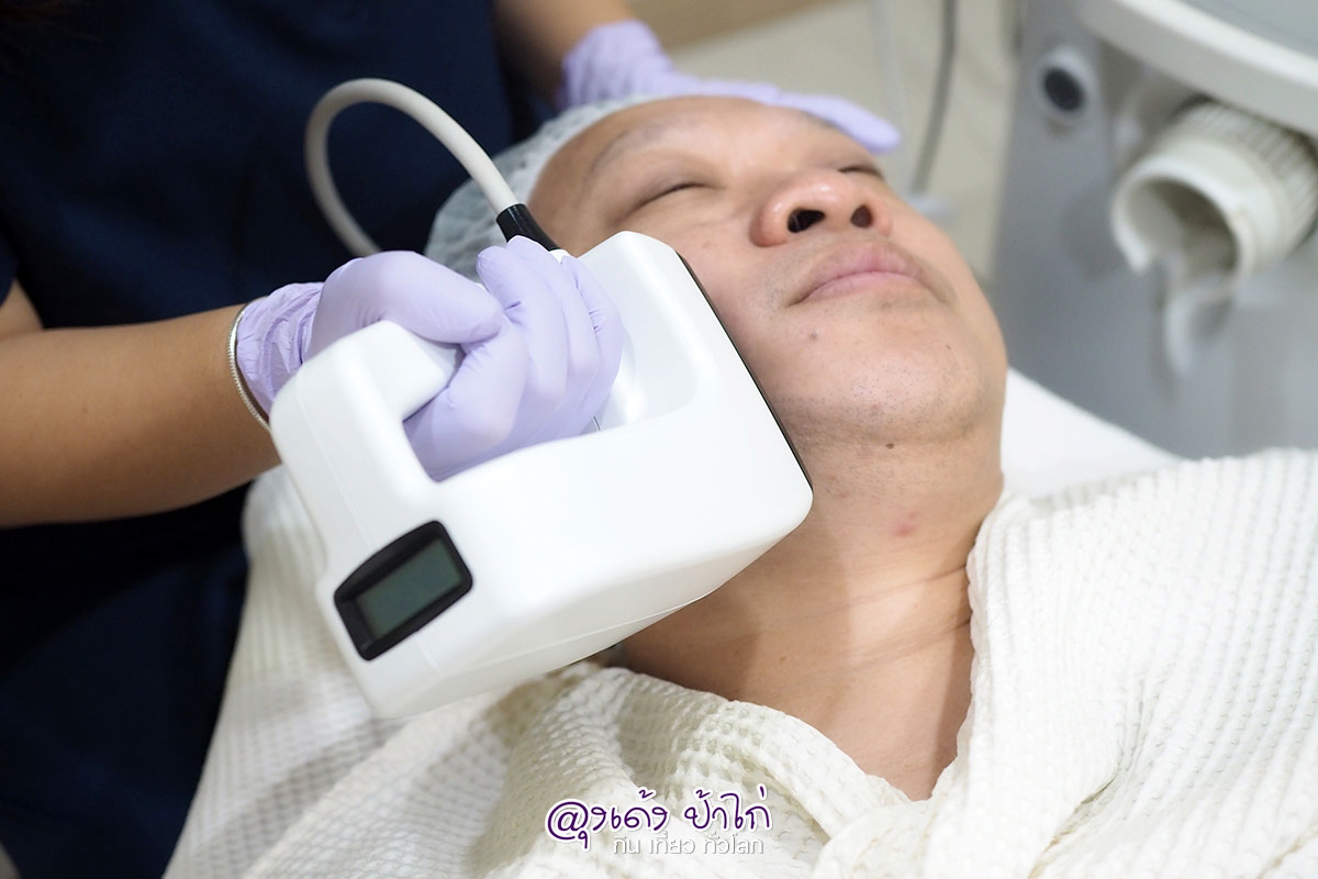 InMode Lifting รีวิว ยกกระชับ กรอบหน้าชัดขึ้น : Proderma - รีวิว by ลุง ...