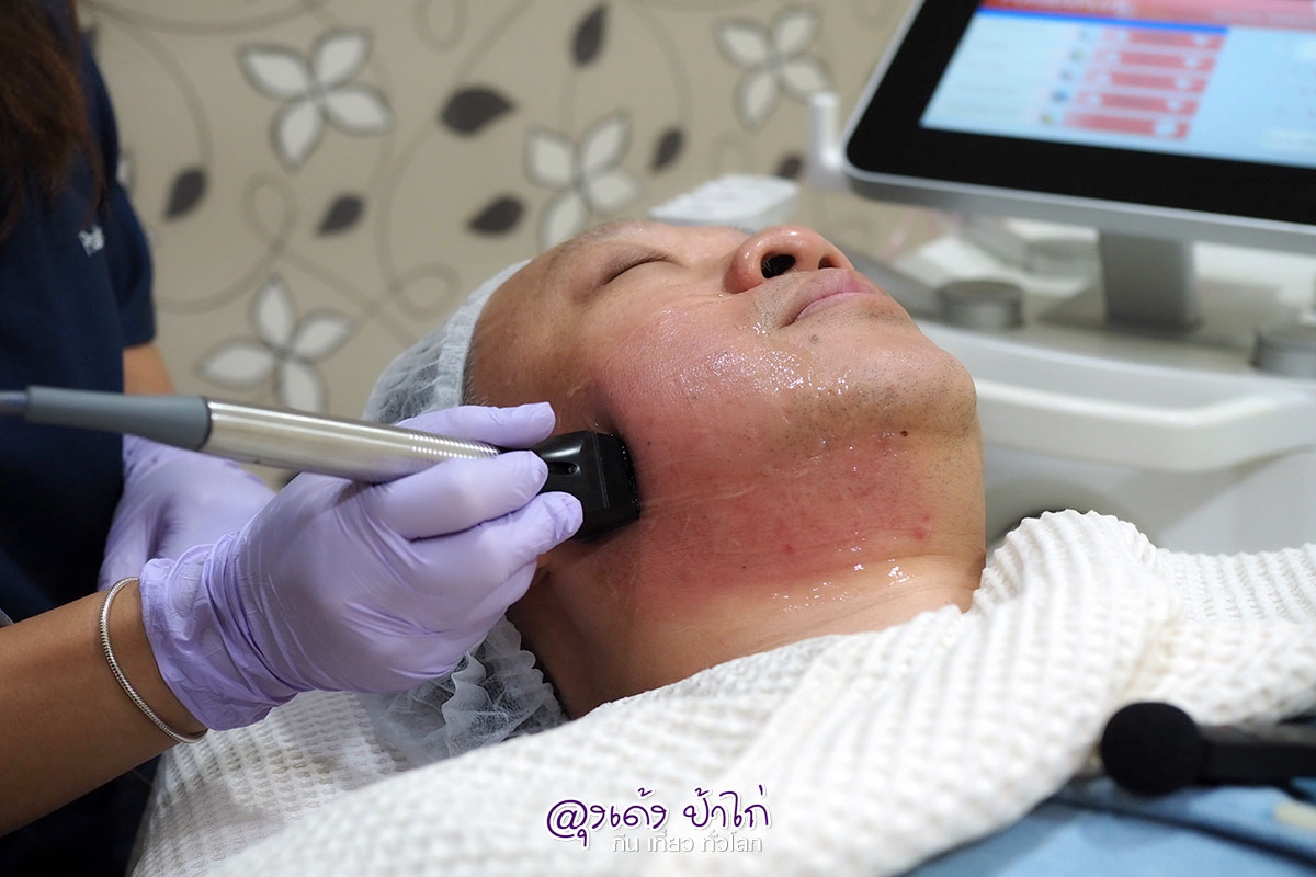 InMode Lifting รีวิว ยกกระชับ กรอบหน้าชัดขึ้น : Proderma - รีวิว by ลุง ...